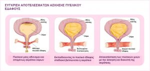 Γυναικεία Ακράτεια Ούρων: Αίτια & Θεραπεία | Π. Κατσίβας